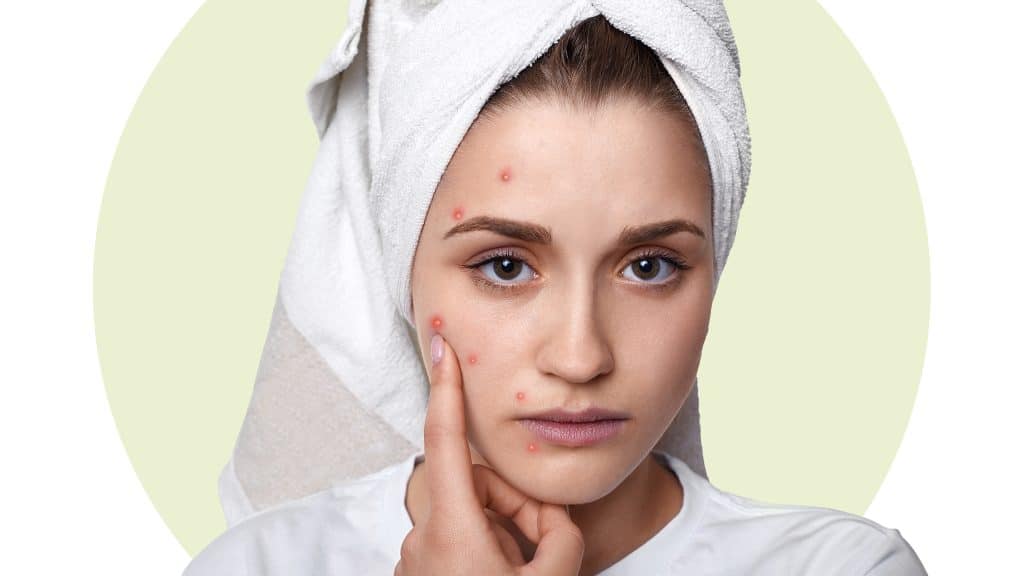 Acne comedonica: cos'è e come si cura con rimedi naturali - Plantadea